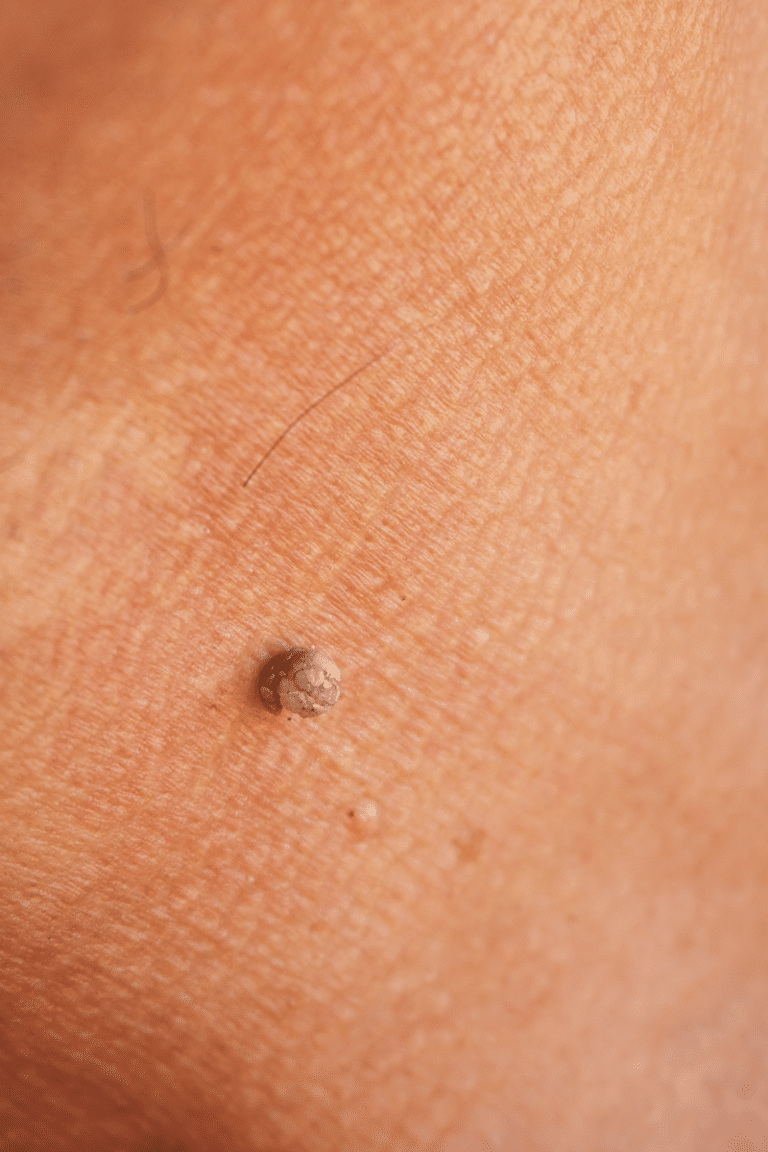 Seborrheic Keratosis | Smart Skin Dermatology in Lehi, Utah