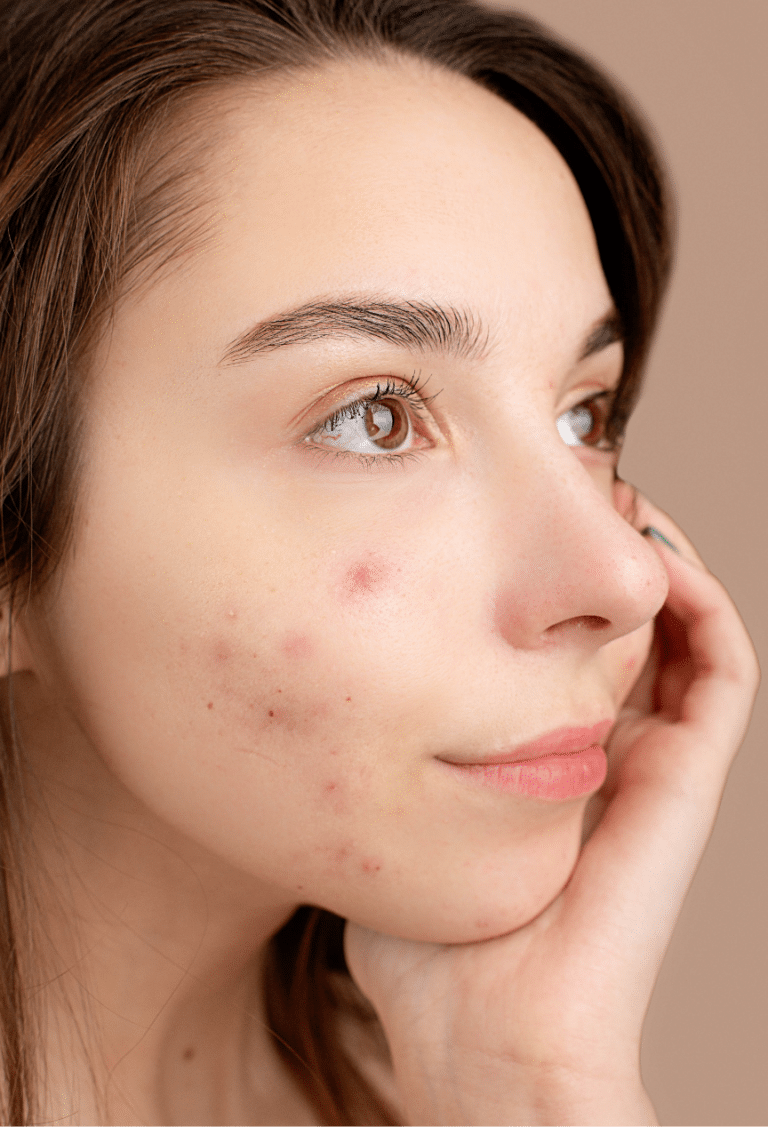 Pilar Cyst Removal in Lehi, Utah | Smart Skin Dermatology