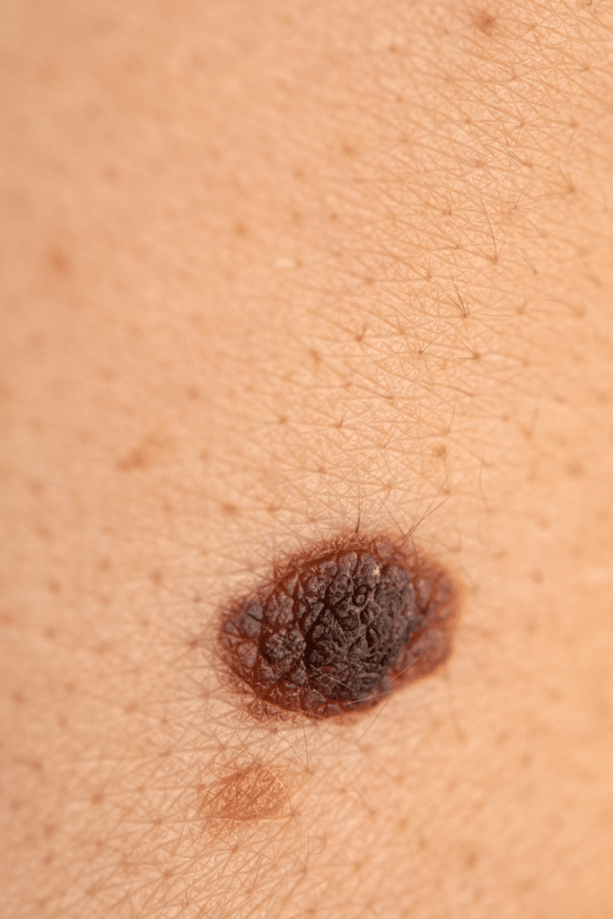 Melanoma Treatment in Lehi, Utah | Smart Skin Dermatology