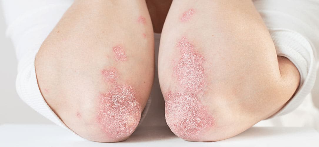 Biologics 101: The Road to Psoriasis Therapy