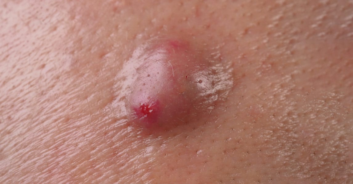 Can a Dermatologist Remove a Cyst? | Smart Skin Dermatology