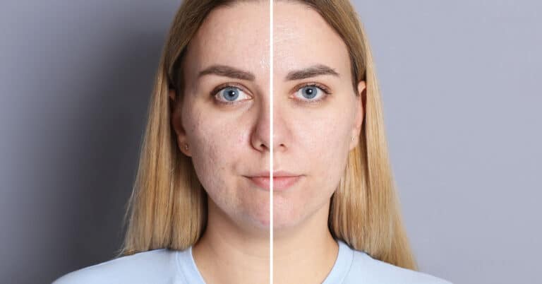 How to Get on Accutane: Your Complete 2024 Guide
